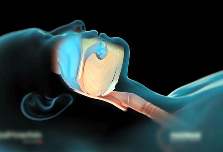 ¿Qué es la apnea del sueño y por qué es peligrosa? | Teletica