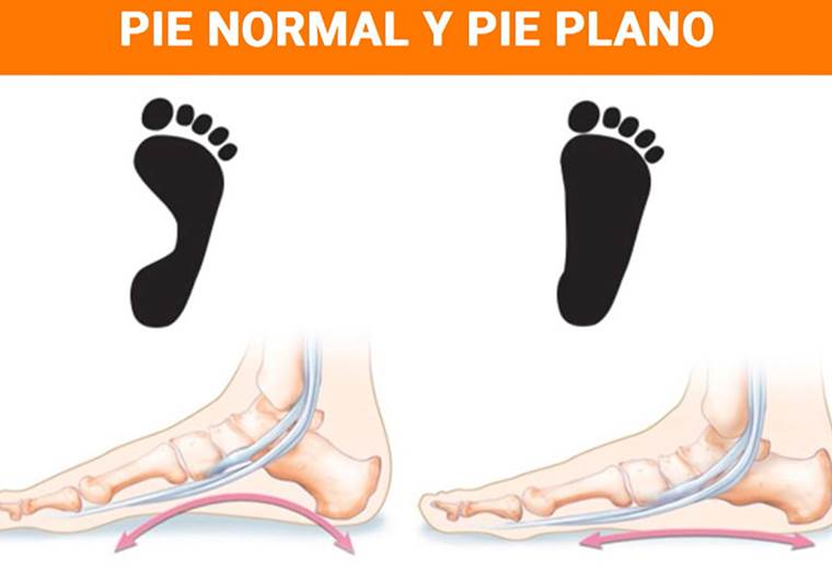 Conozca las consecuencias del pie plano | Teletica