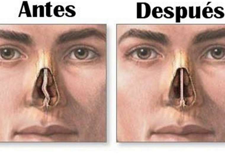 ¿Tiene el tabique nasal desviado? Estas podrían ser las consecuencias ...