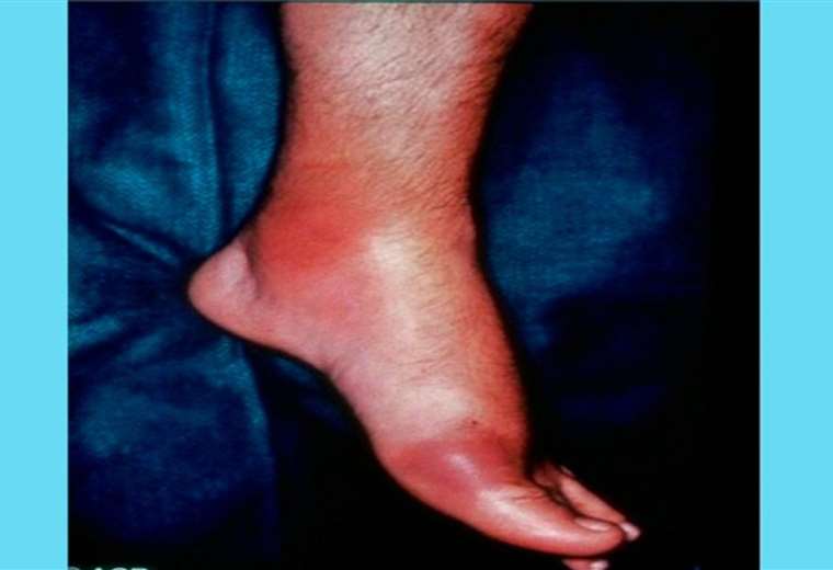 Hablamos sobre la gota: causas, síntomas y tratamientos | Teletica