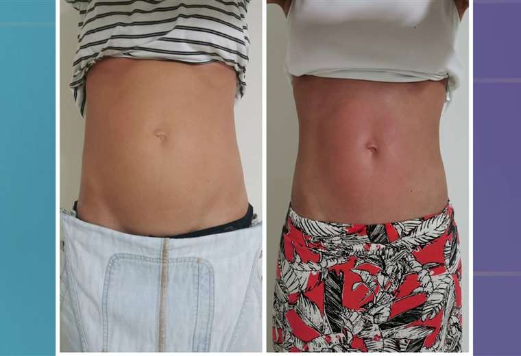 ¿Qué es la diástasis abdominal y cómo se trata? | Teletica