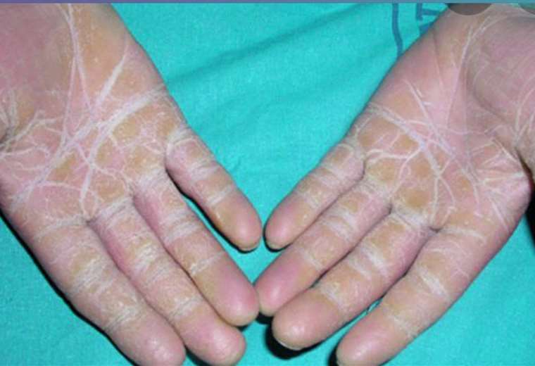 Descubra las múltiples causas de la piel seca y cómo puede tratarla ...
