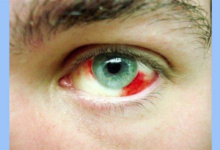 No ignore las manchas rojas en los ojos, podría tener una hemorragia ...