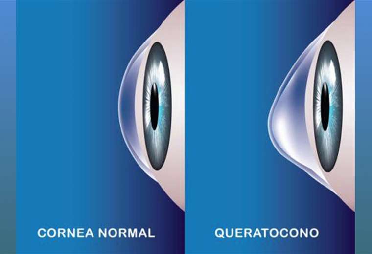 Queratocono: causas y tratamientos | Teletica